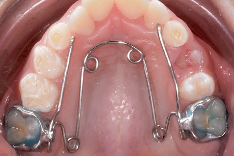 Les appareils fixes - Sandrine Gros - Chirurgien dentiste, spécialiste ...